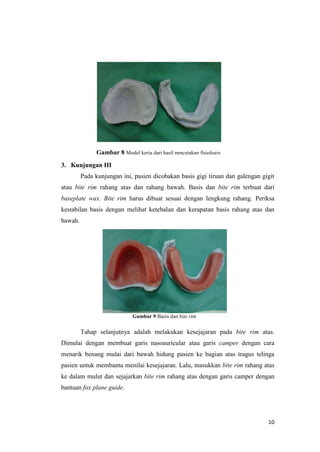 penatalaksanaan gigitiruan penuh lepasan pada pasien edentulous | DOCX