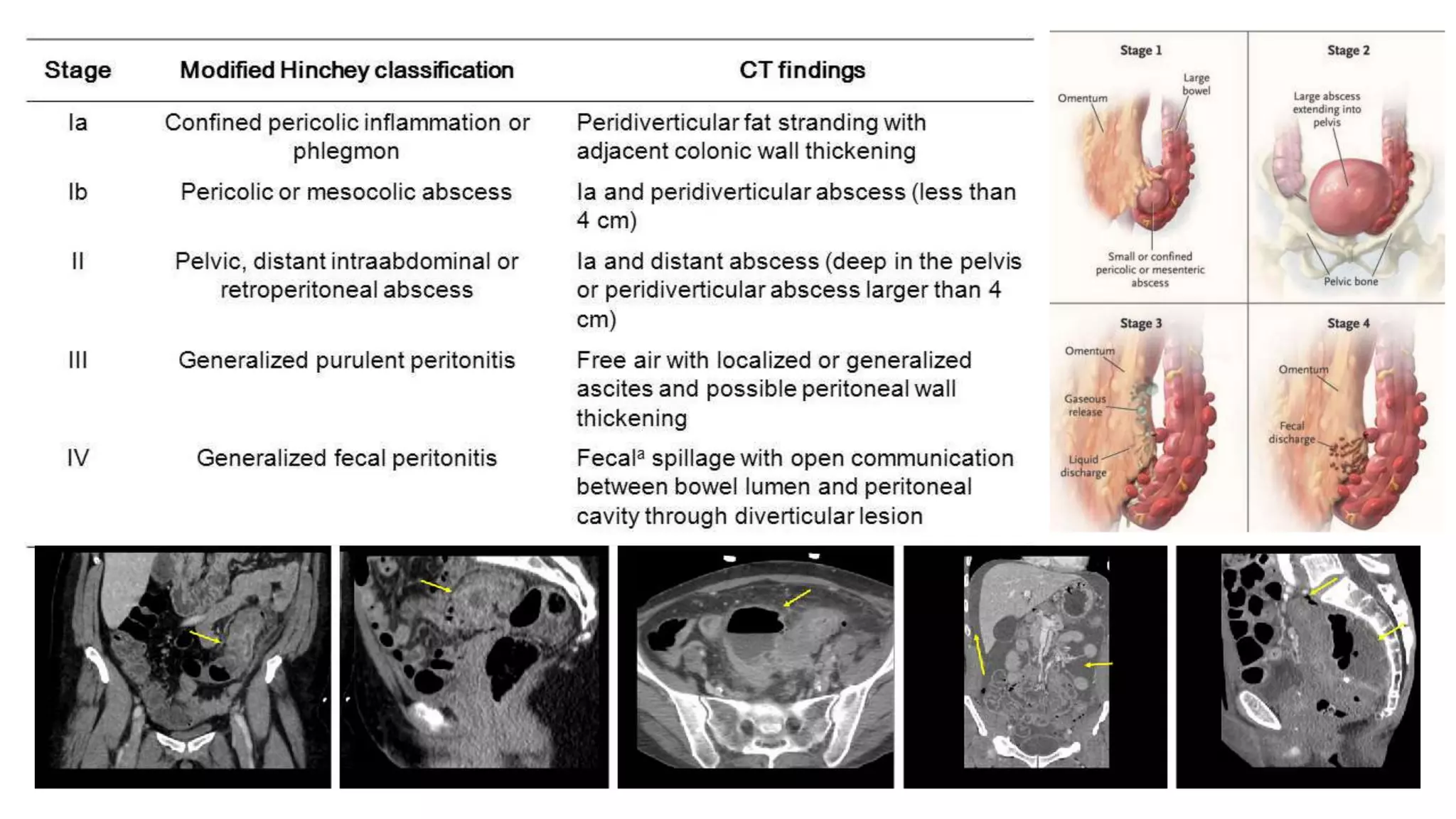 Acute Diverticulitis.pptx