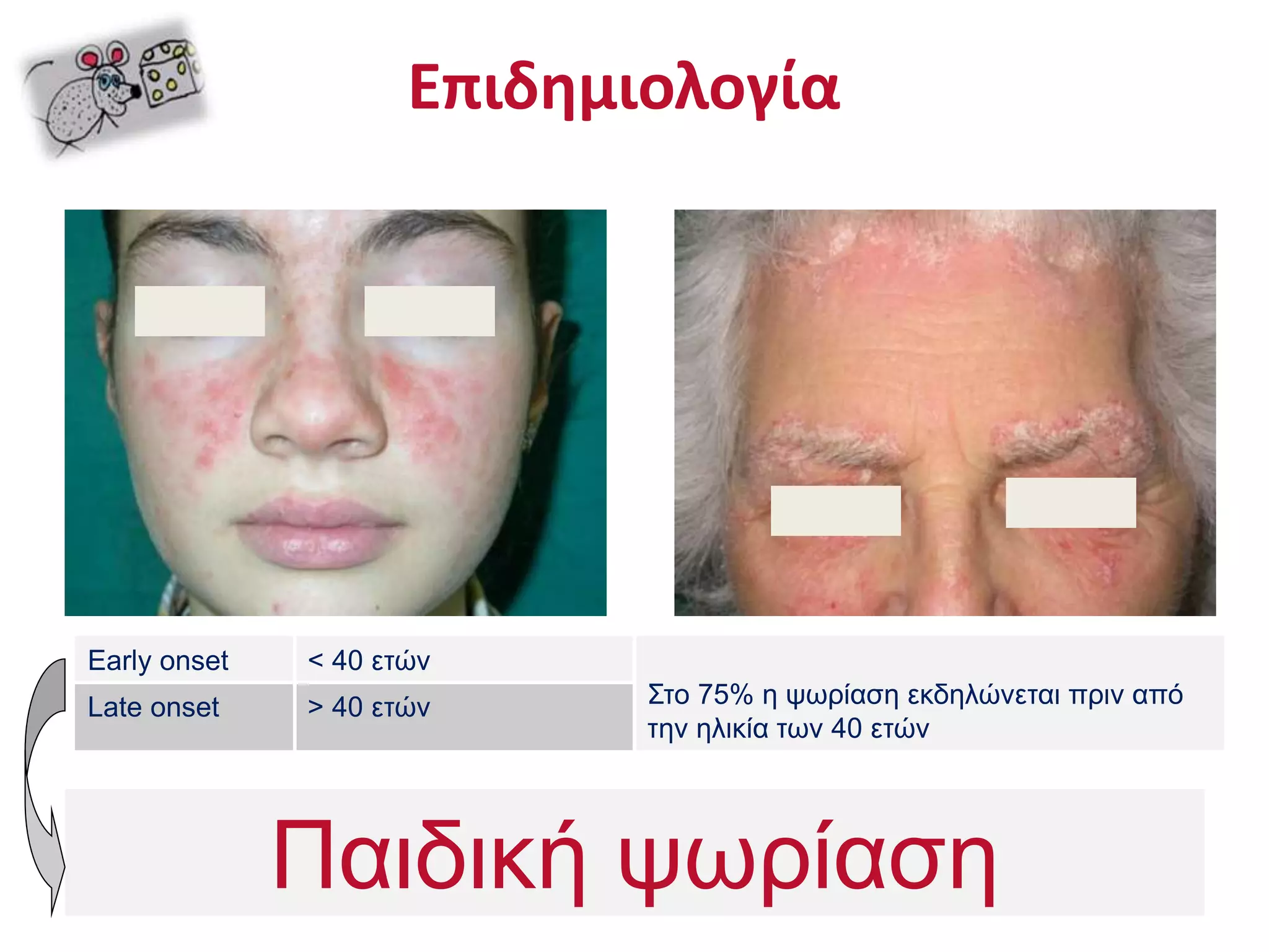 Παιδική Ψωρίαση | PPT