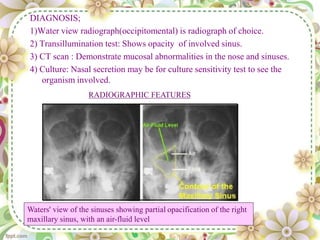 maxillary sinus seminar | PPTX
