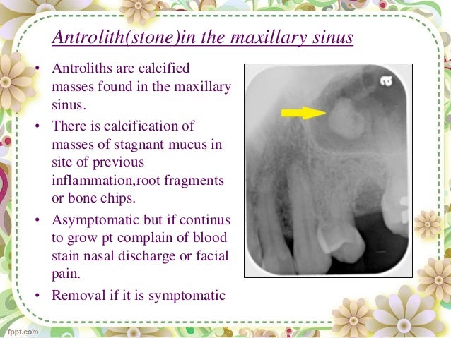 maxillary sinus seminar