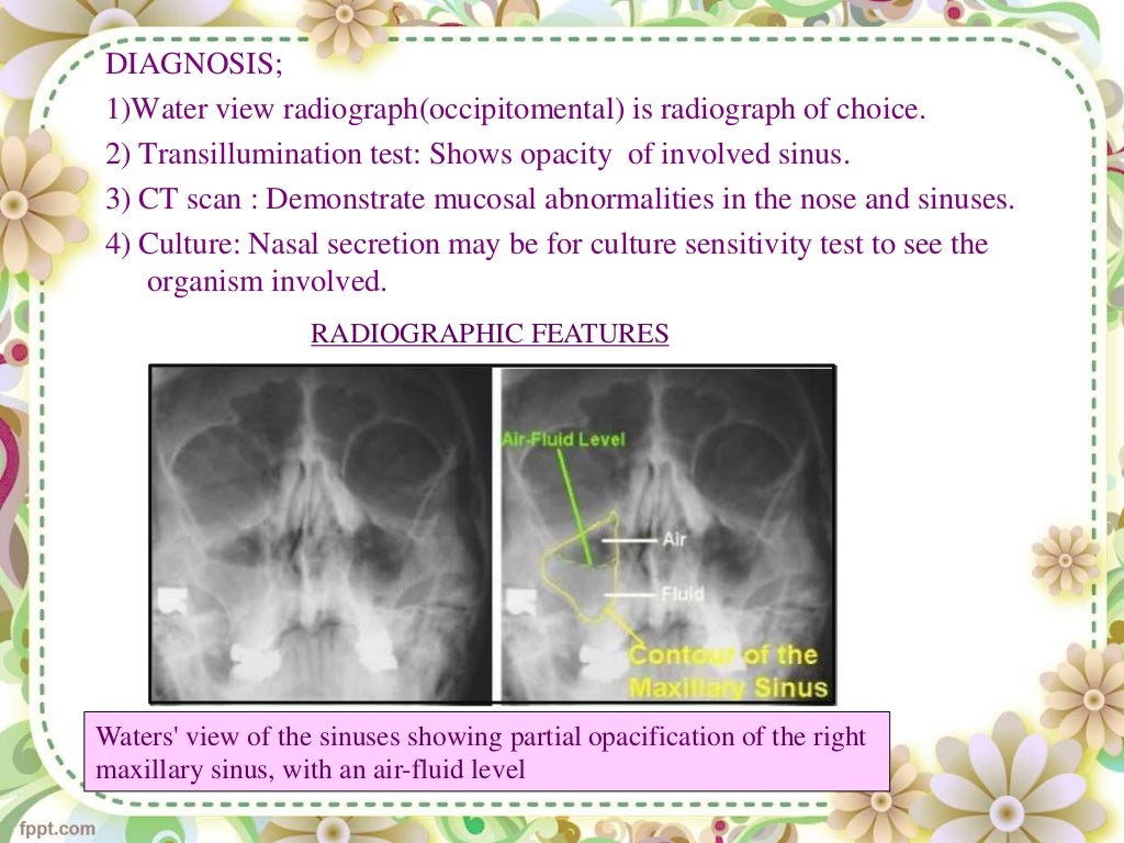 Maxillary Sinus Seminar