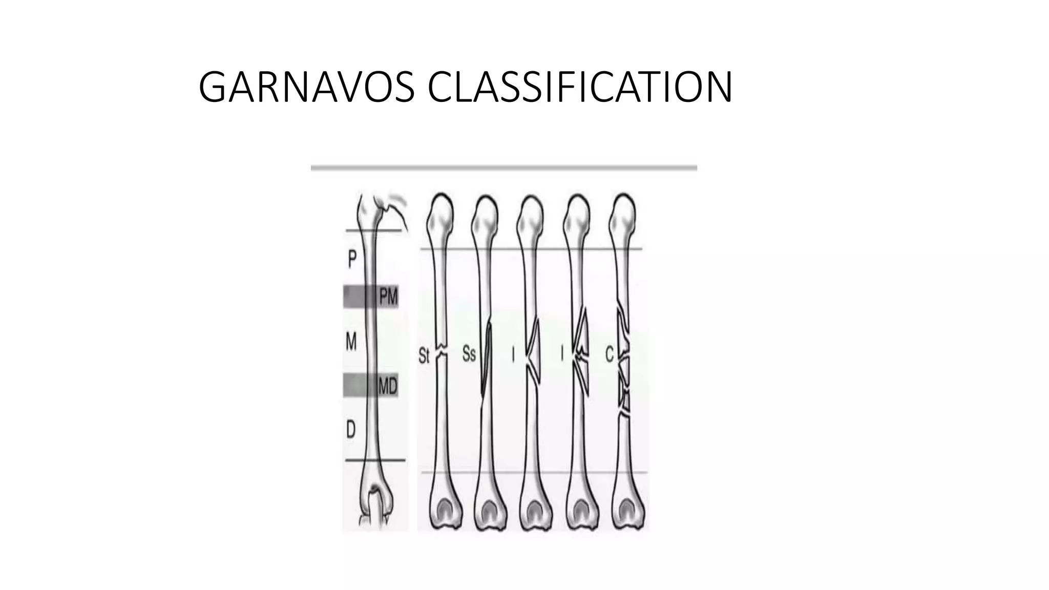 fracture shaft of humerus2021 | PPTX