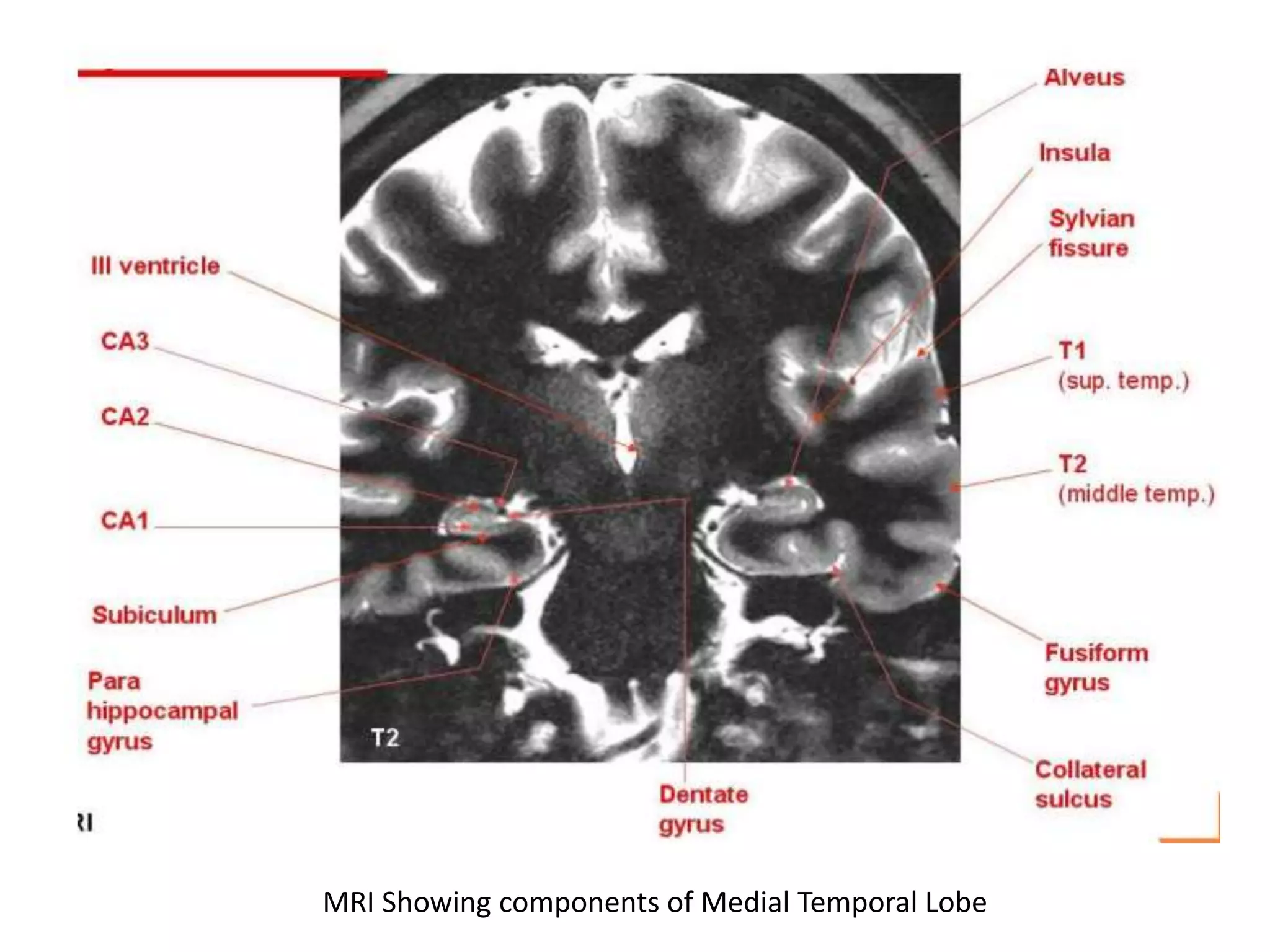Final microsurgical anatomy of medial temporal lobe | PPTX