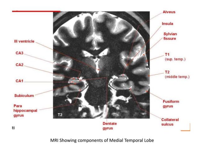 Final microsurgical anatomy of medial temporal lobe | PPTX | Brain and ...