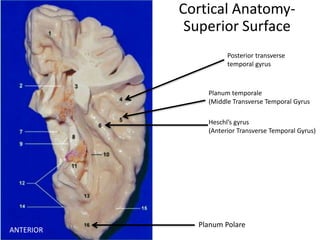 Transverse Temporal Gyrus Anatomy