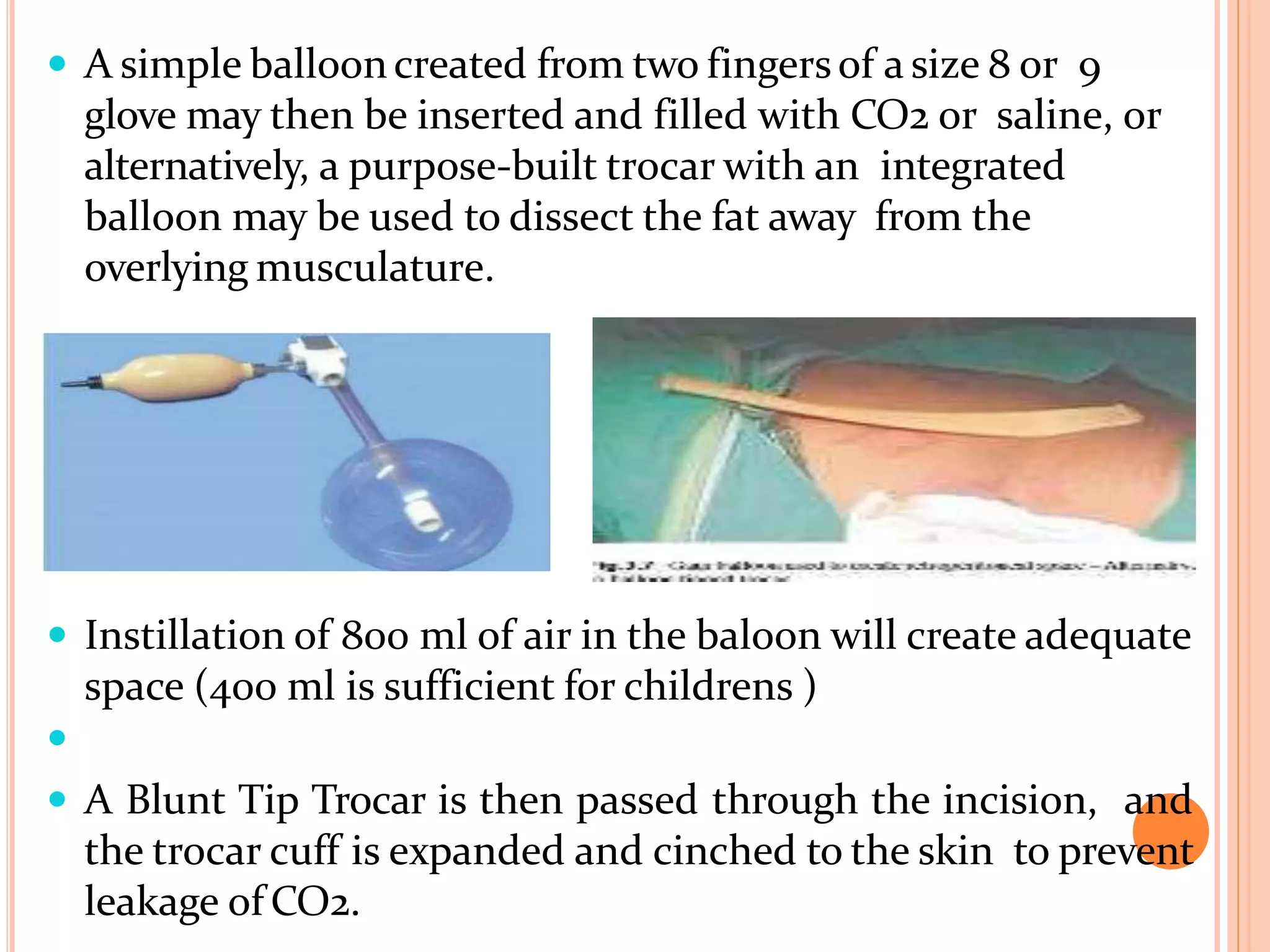 LAP PYELOPLASTY | PPT