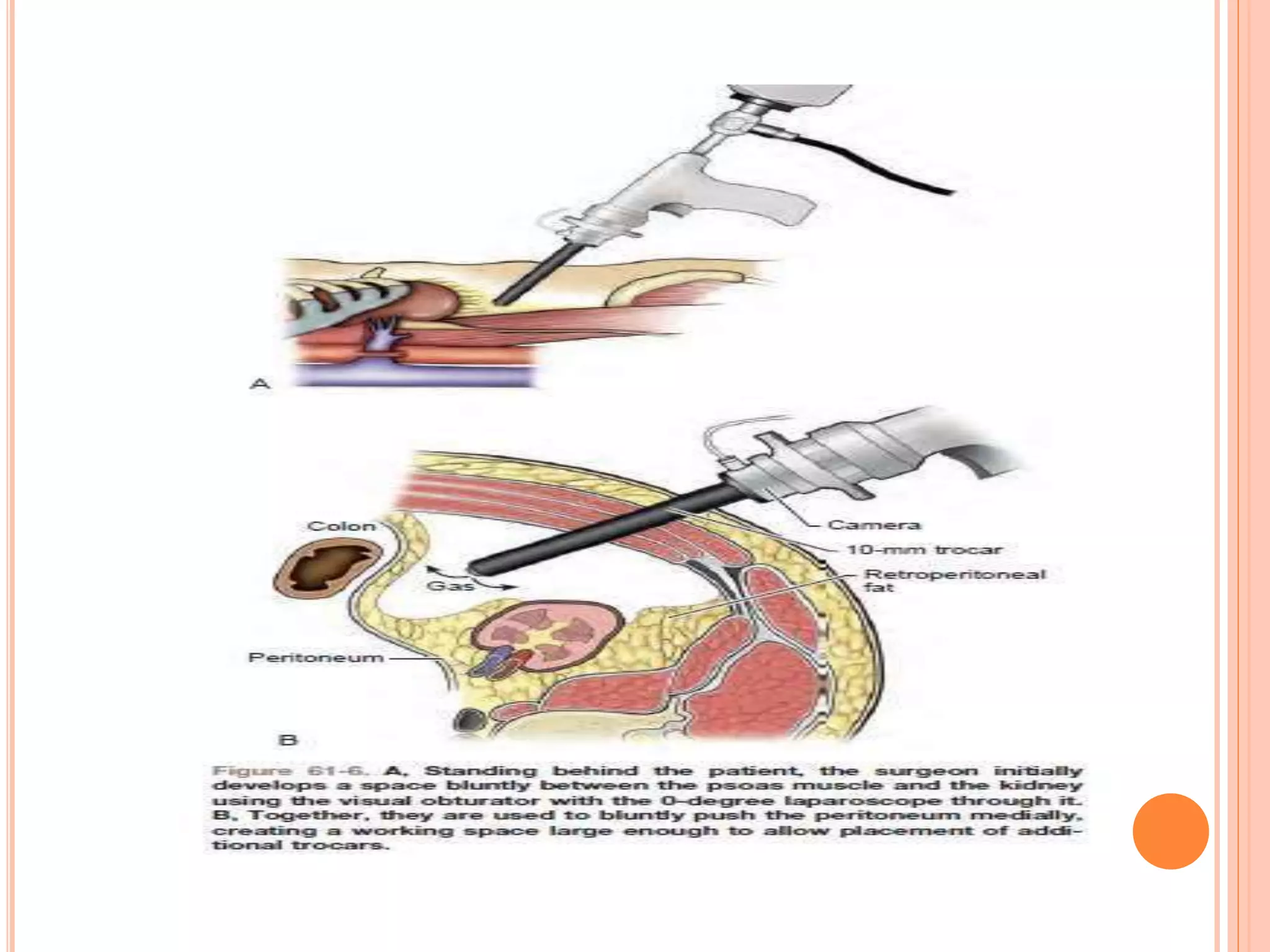 LAP PYELOPLASTY | PPTX