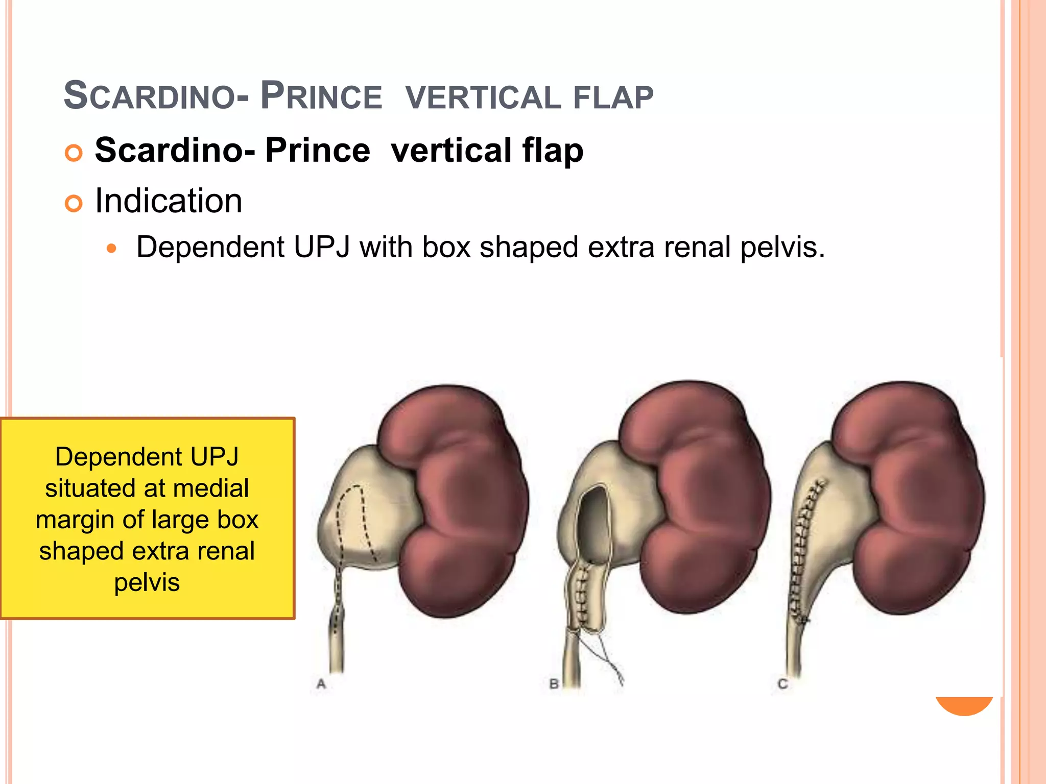 LAP PYELOPLASTY | PPTX