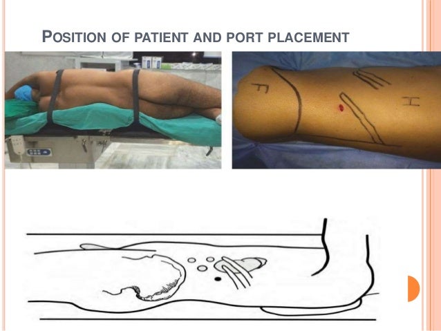 LAP PYELOPLASTY