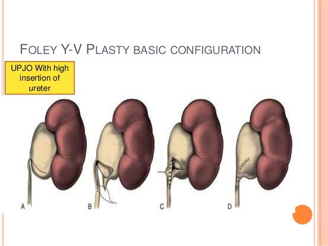 LAP PYELOPLASTY