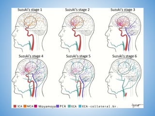 classification, pathophysiology and surgical management MOYAMOYA.pptx
