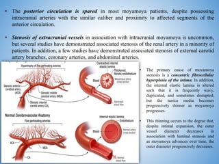 classification, pathophysiology and surgical management MOYAMOYA.pptx