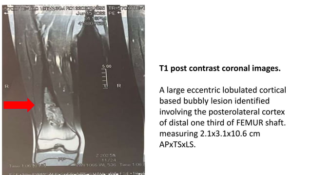 FINAL NON OSSIFYIG FIBROMA -.pptx