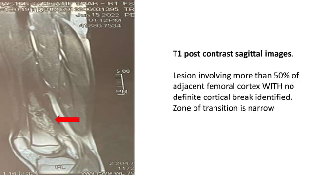 FINAL NON OSSIFYIG FIBROMA -.pptx