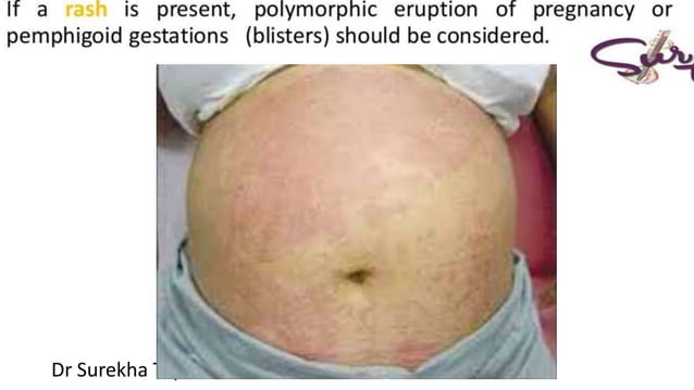 Intrahepatic Cholestasis of Pregnancy - Prof Surekha Tayade | PPTX