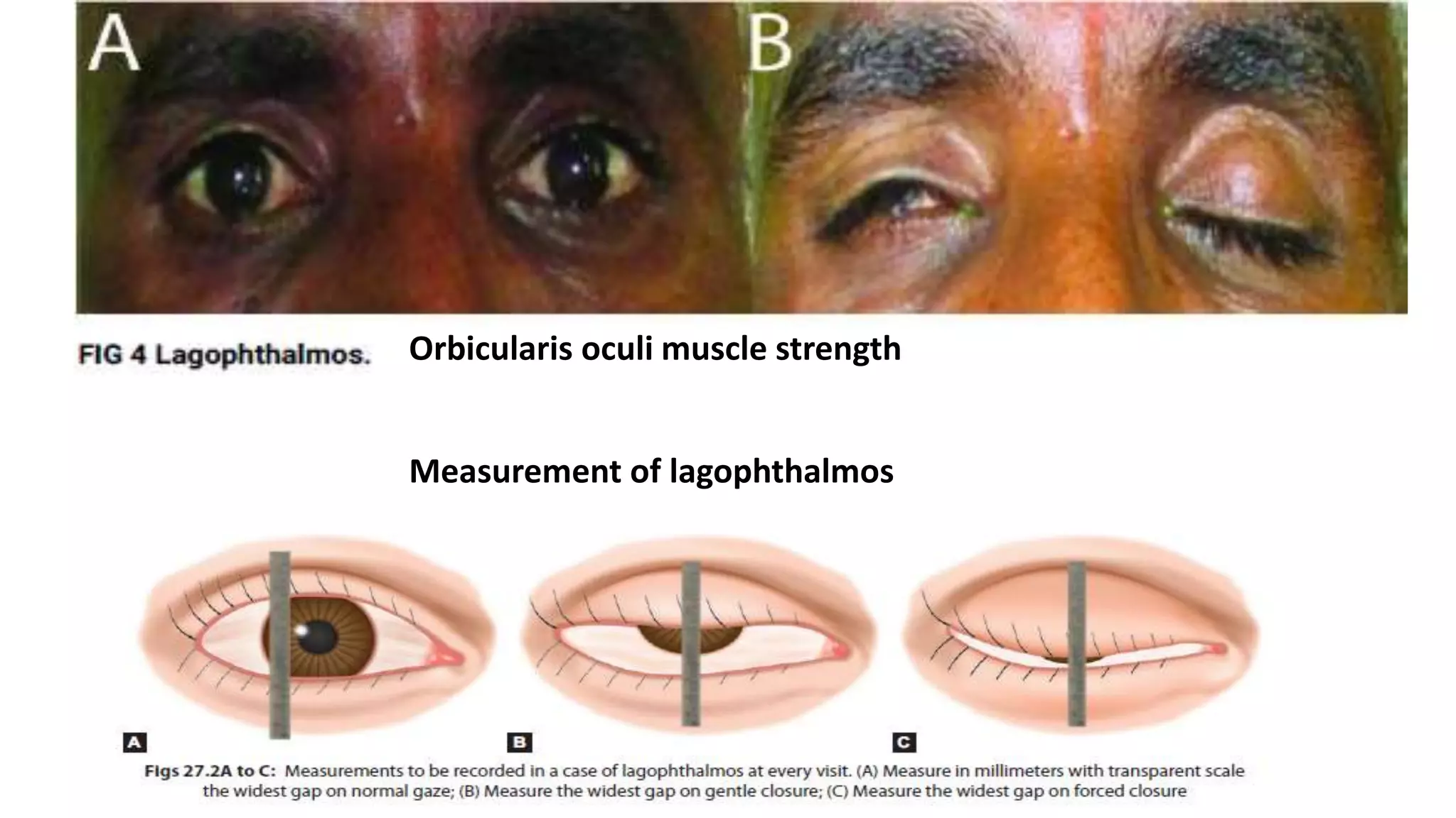 Ocular Manifestations of Leprosy - EYE | PPTX