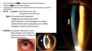 Ocular Manifestations of Leprosy - EYE | PPTX | Eye and Vision ...