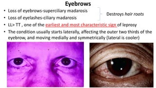 Ocular Manifestations of Leprosy - EYE | PPTX