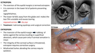 Ocular Manifestations of Leprosy - EYE | PPTX