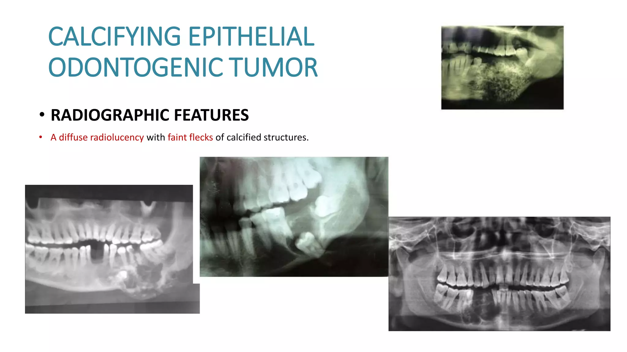Odontogenic Tumors Oral Pathology | PPTX