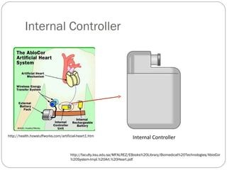 Abiocor Artificial Heart