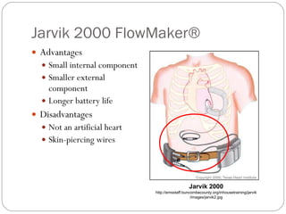 Jarvik 2000