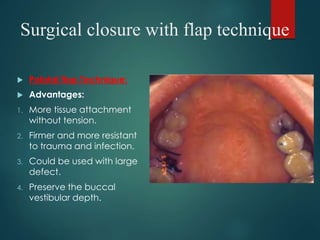Oroantral Communication and Fistula | PPTX