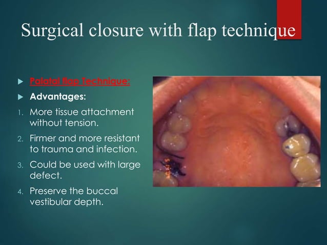 Oroantral Communication and Fistula | PPTX | Ear, Nose and Throat ...