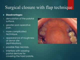 Oroantral Communication and Fistula | PPTX