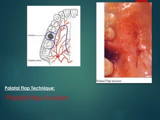 Oroantral Communication and Fistula | PPTX