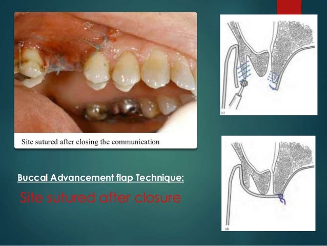 Oroantral Communication and Fistula