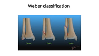 Injuries fractures of leg foot and kneee | PPTX