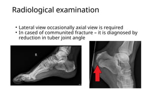 Injuries fractures of leg foot and kneee | PPTX