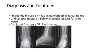 Injuries fractures of leg foot and kneee | PPTX