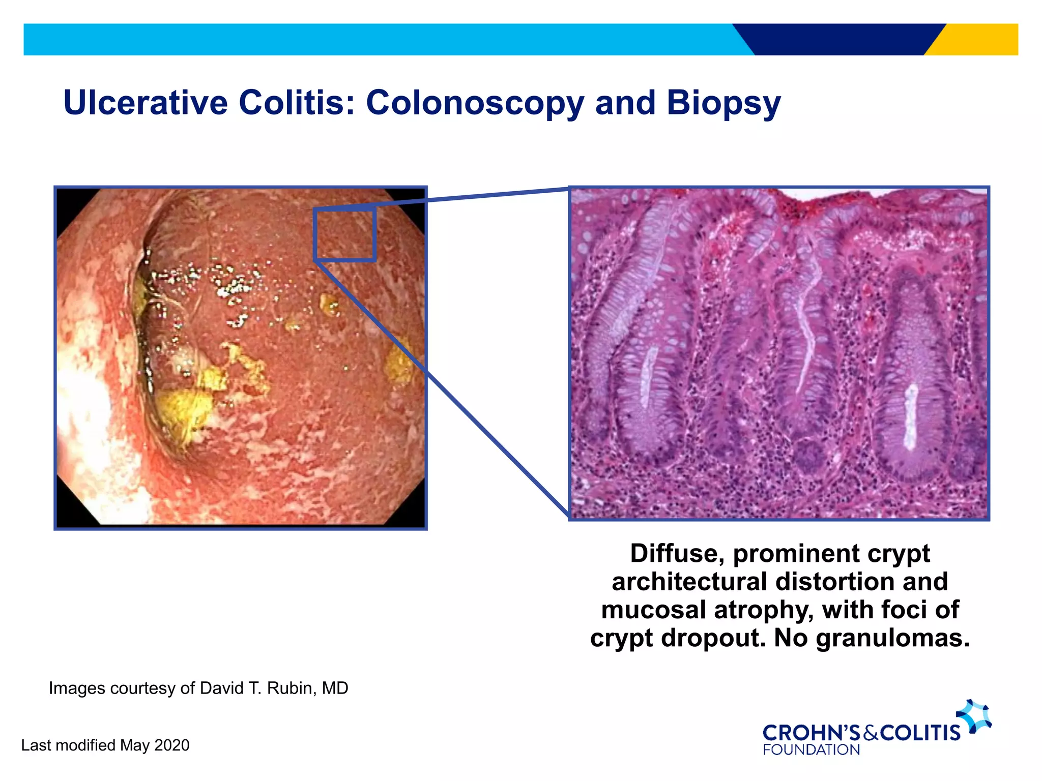 Overview of IBD for Healthcare Professionals | PDF