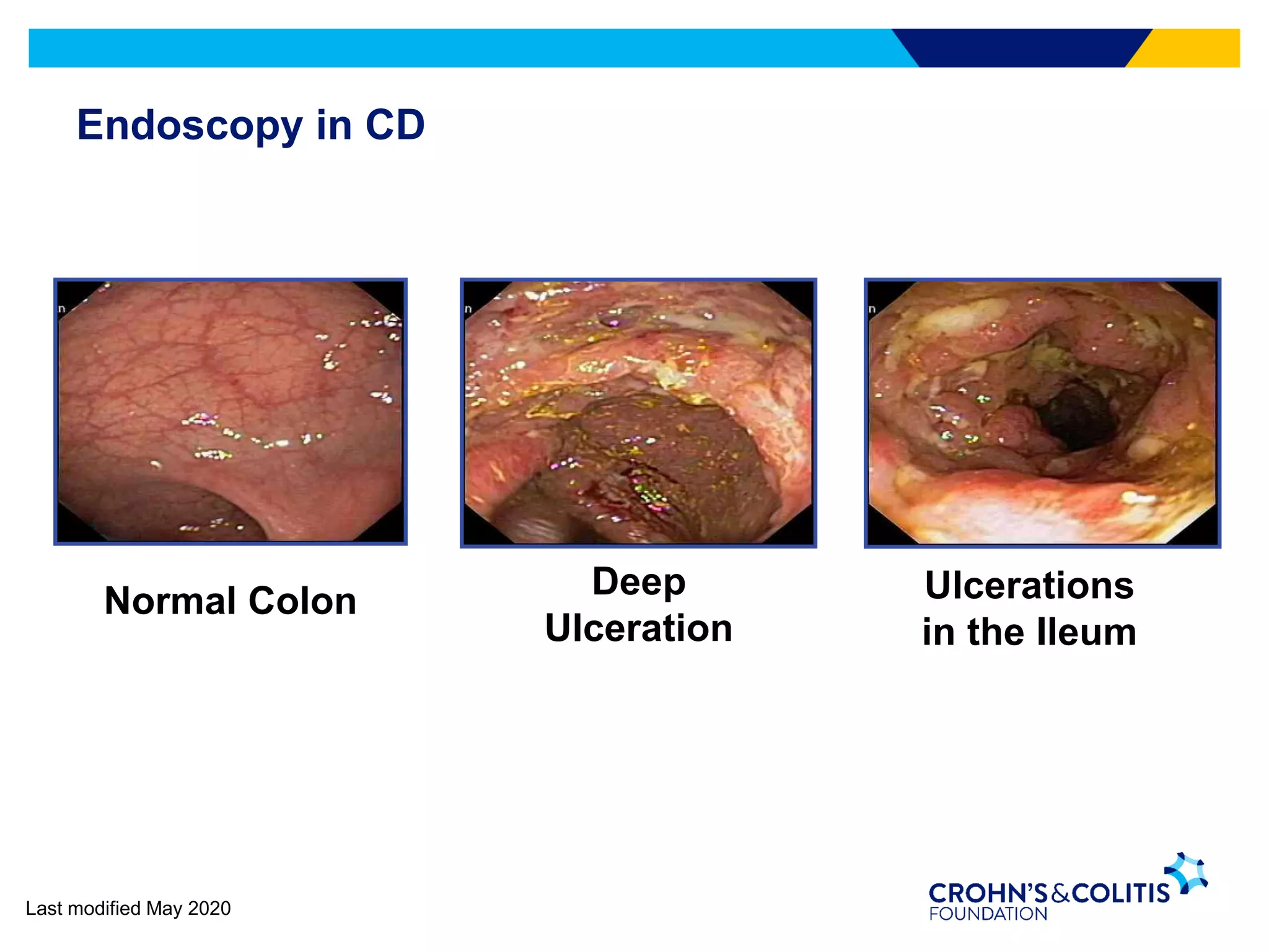 Overview of IBD for Healthcare Professionals | PDF