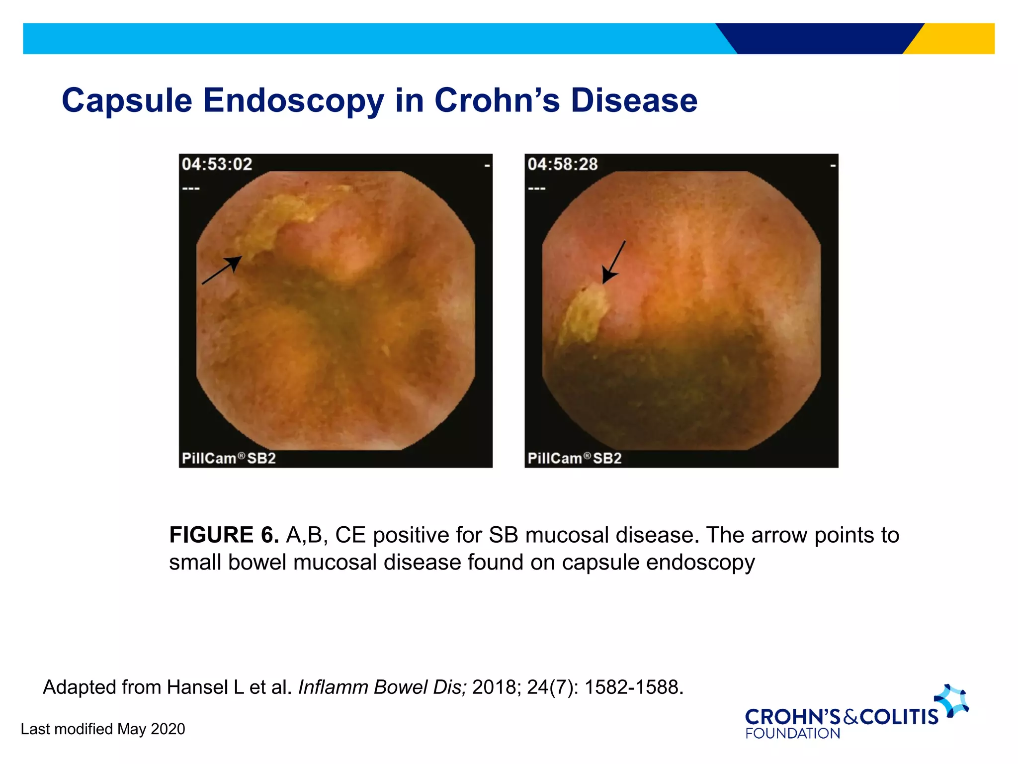 Overview of IBD for Healthcare Professionals | PDF