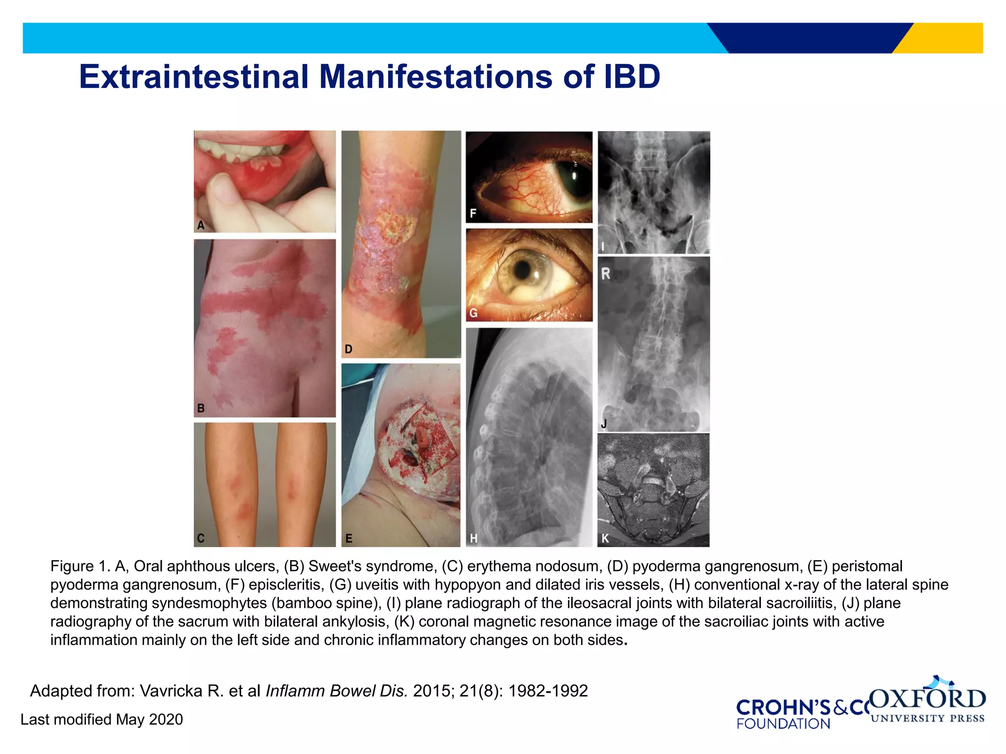 Overview of IBD for Healthcare Professionals | PDF