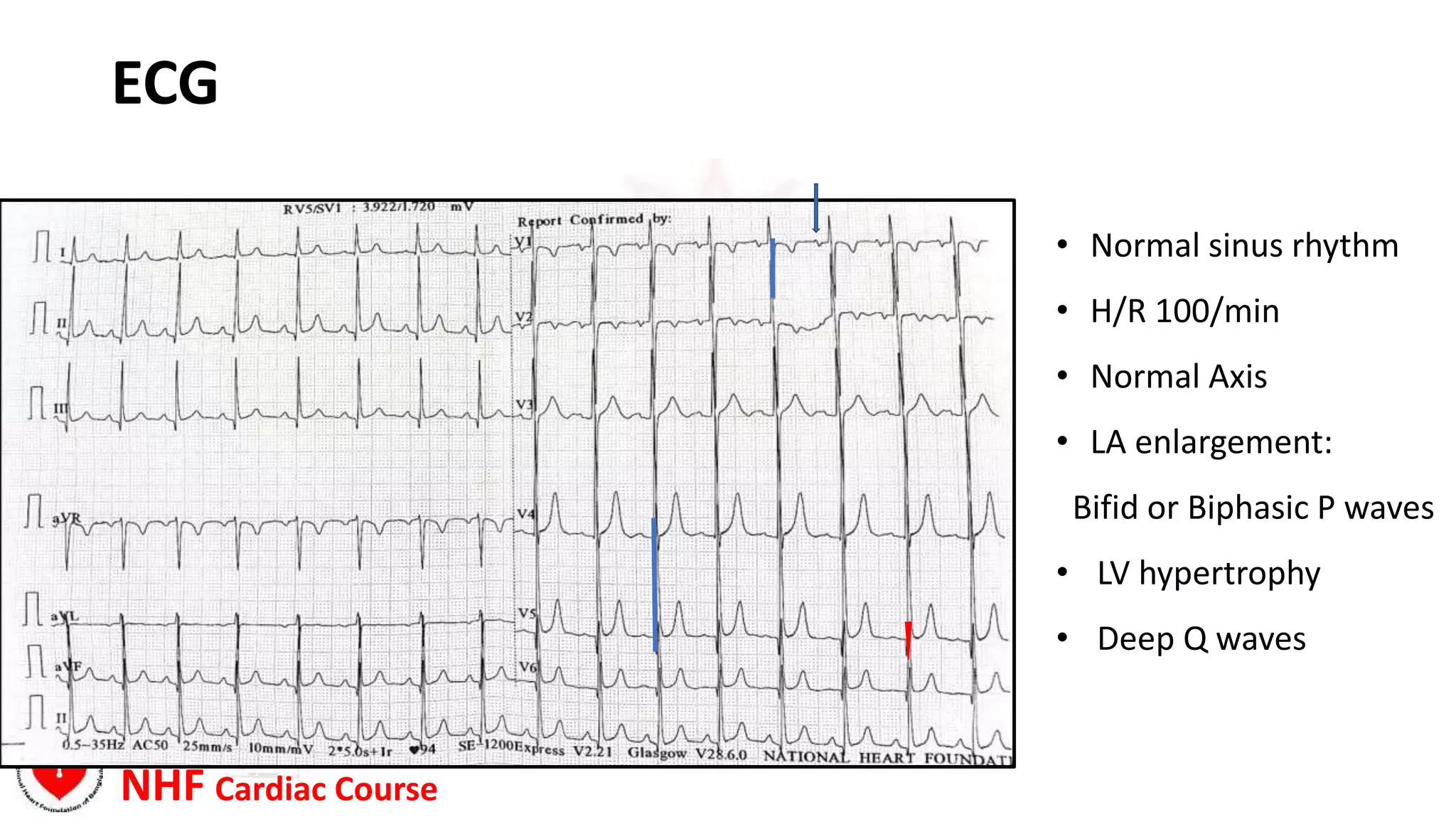 Patent Ductus Arteriosus Clinical Manifestation And Diagnosis Pptx