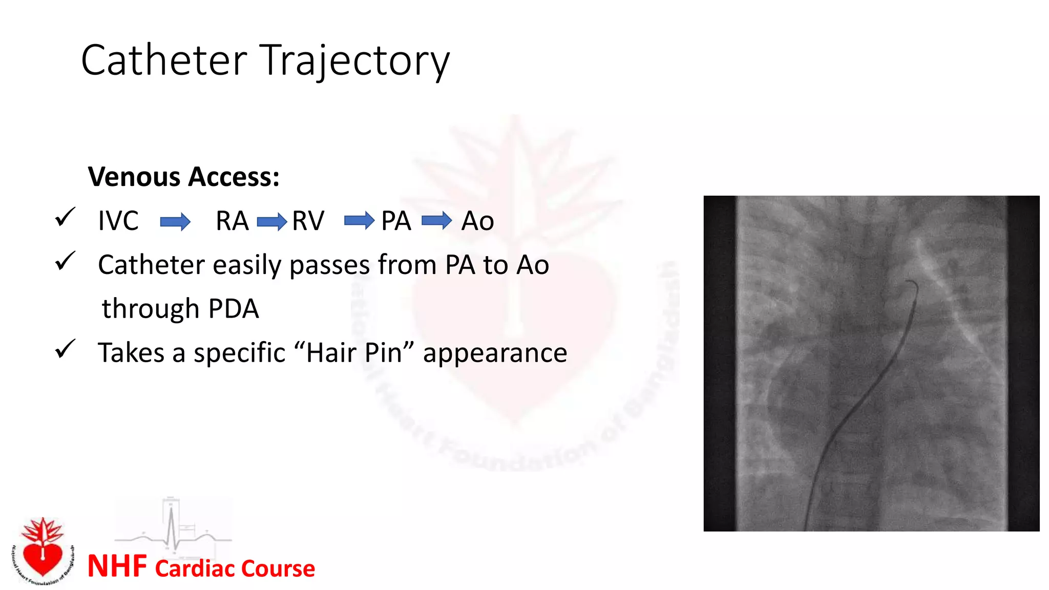Patent Ductus Arteriosus: Clinical manifestation and Diagnosis | PPTX