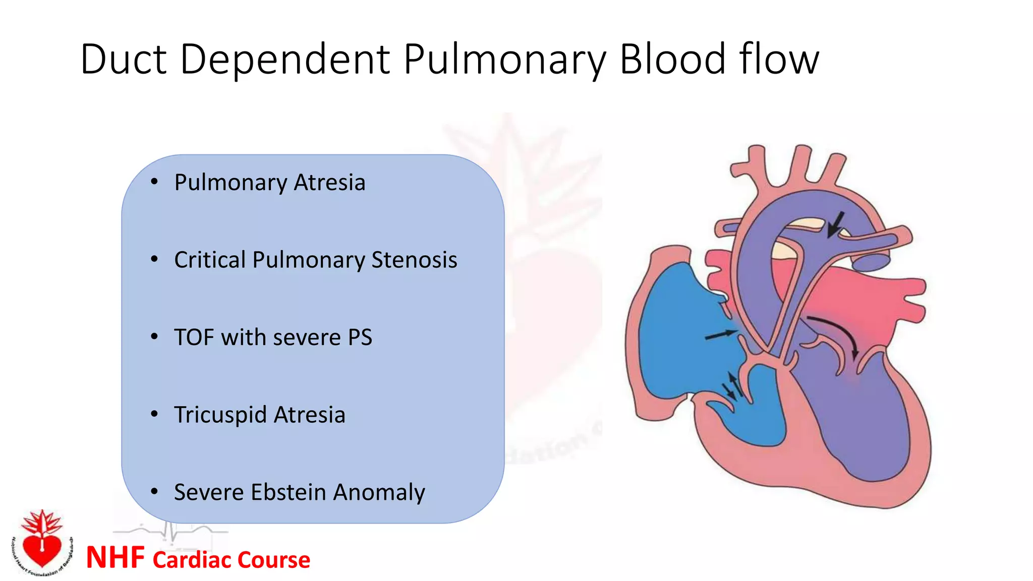 Patent Ductus Arteriosus: Clinical manifestation and Diagnosis | PPTX