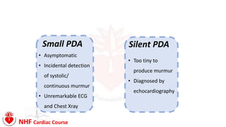 Patent Ductus Arteriosus: Clinical manifestation and Diagnosis | PPT