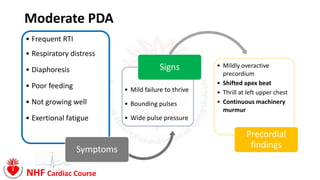 Patent Ductus Arteriosus: Clinical manifestation and Diagnosis | PPT