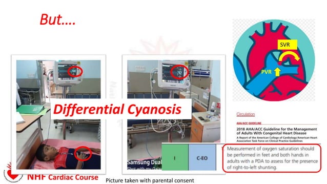 Patent Ductus Arteriosus: Clinical manifestation and Diagnosis | PPT