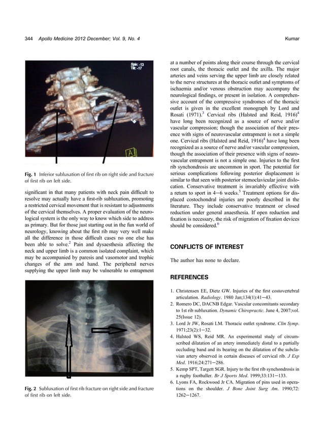 Dislocation of the First Costovertebral Articulation on One Side and ...