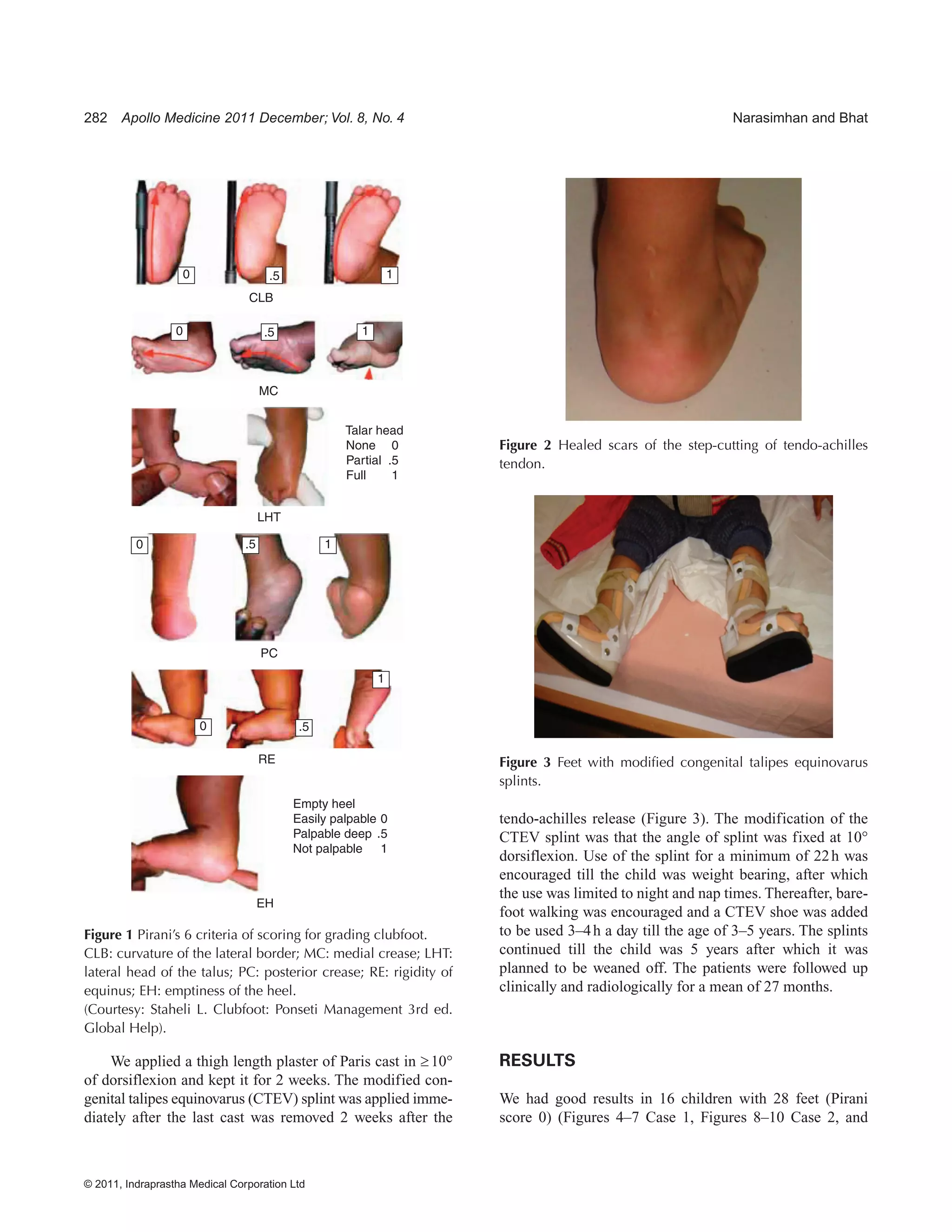 Modified Ponseti Technique of Management of Idiopathic Clubfoot | PDF