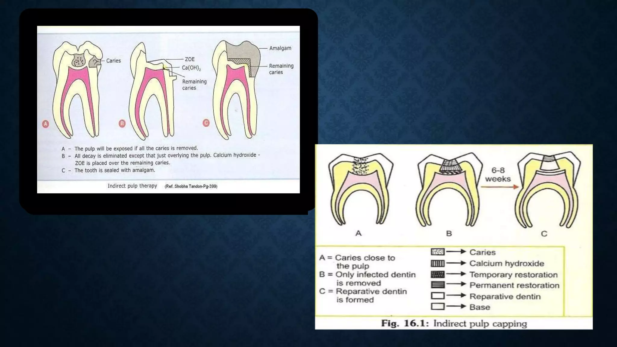 Pediatric Endodontics - Indirect and Direct pulp capping,Pulpotomy ...