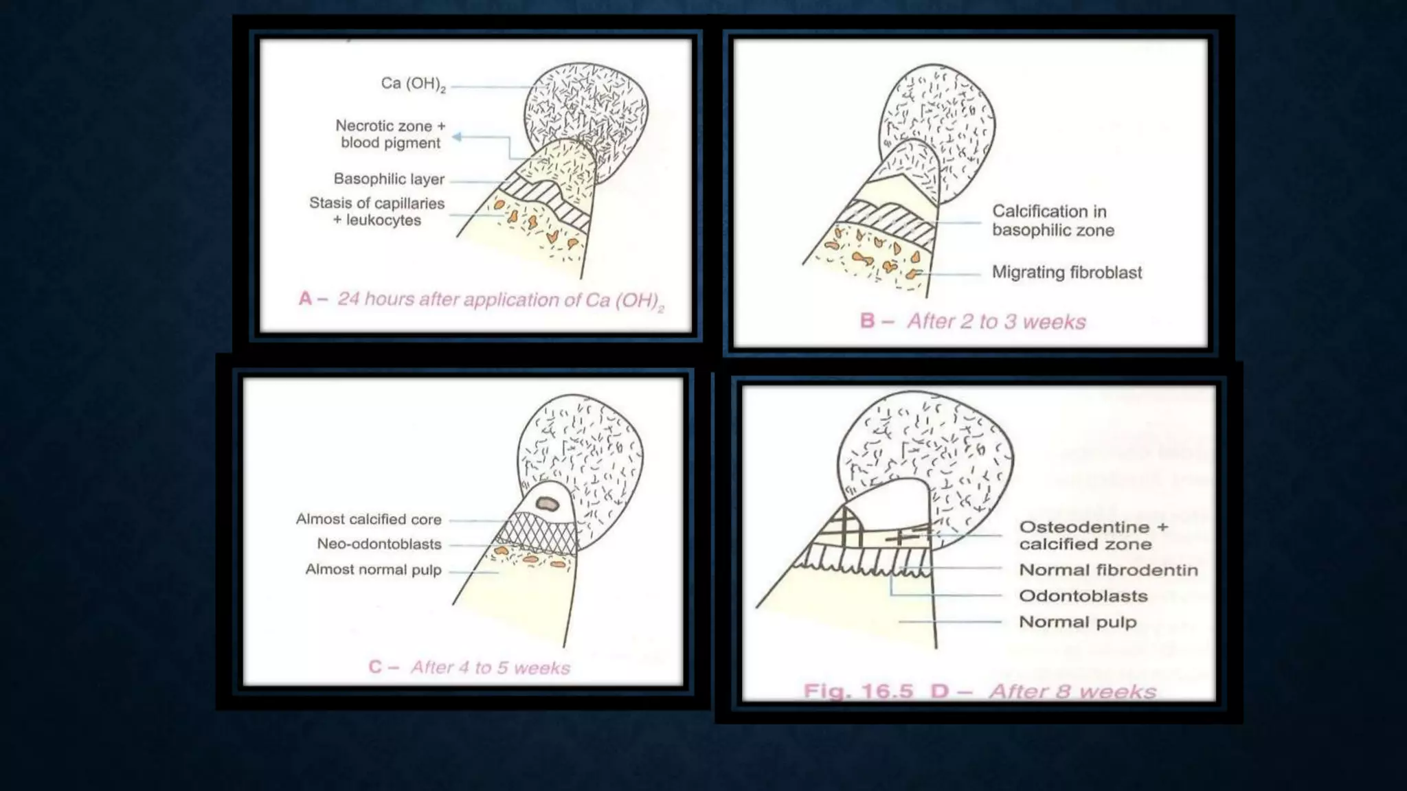 Pediatric Endodontics - Indirect and Direct pulp capping,Pulpotomy ...