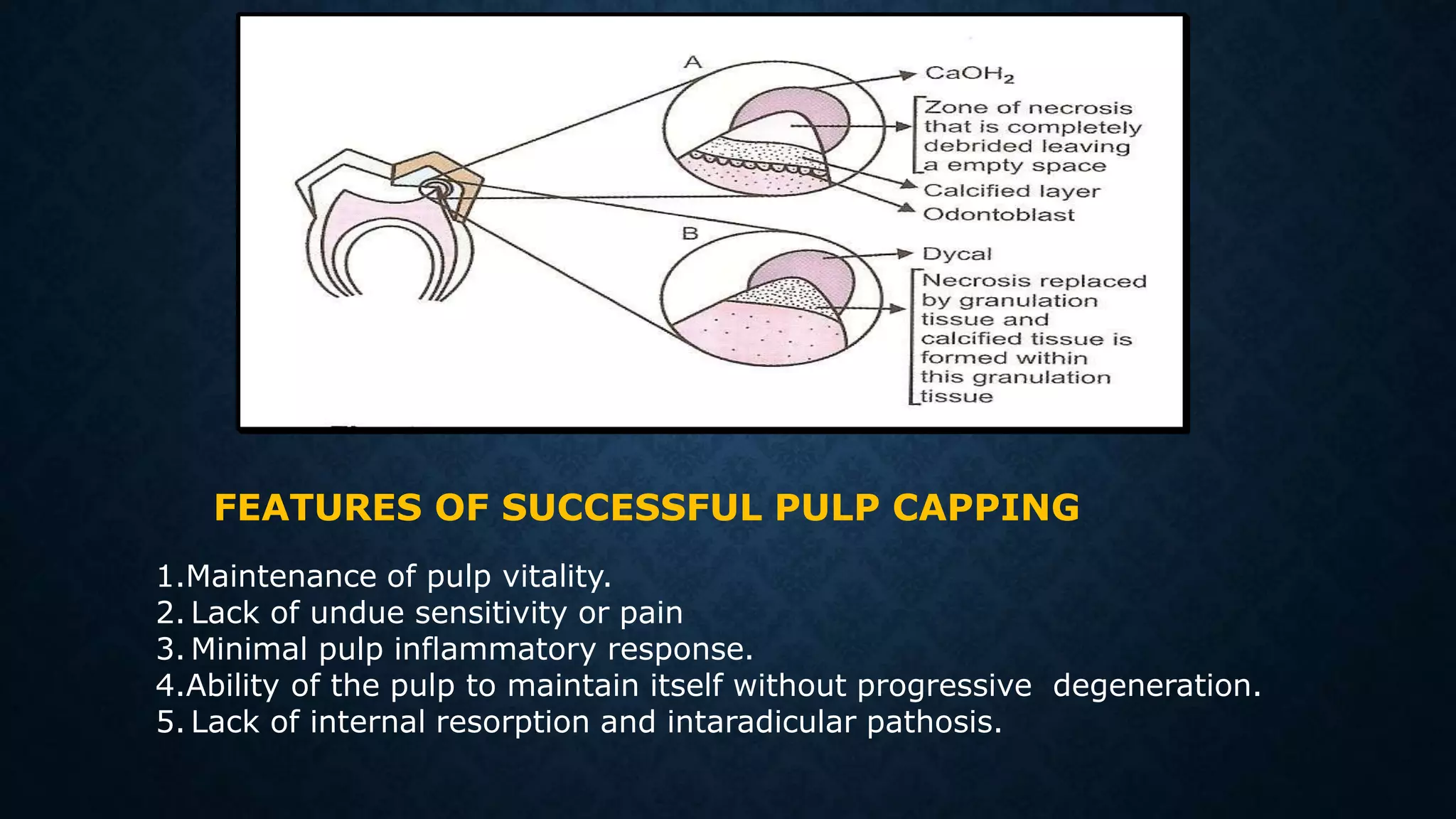Pediatric Endodontics - Indirect and Direct pulp capping,Pulpotomy ...